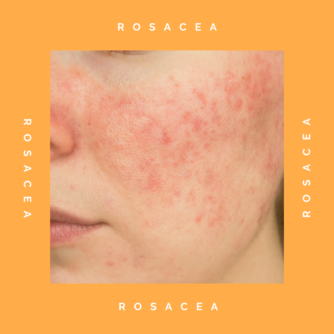 Decoding Rosacea: Insights, Triggers, And Holistic Management Strategi ...